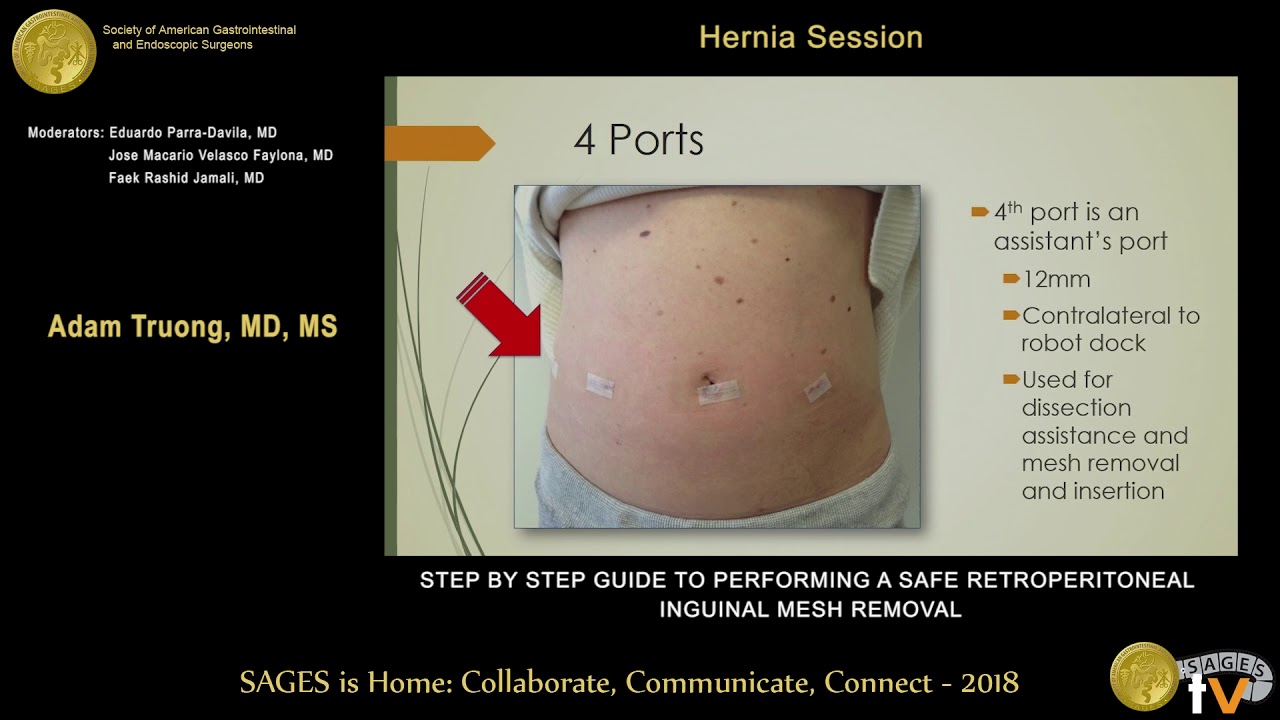 Step by step guide to performing a safe retroperitoneal inguinal mesh ...