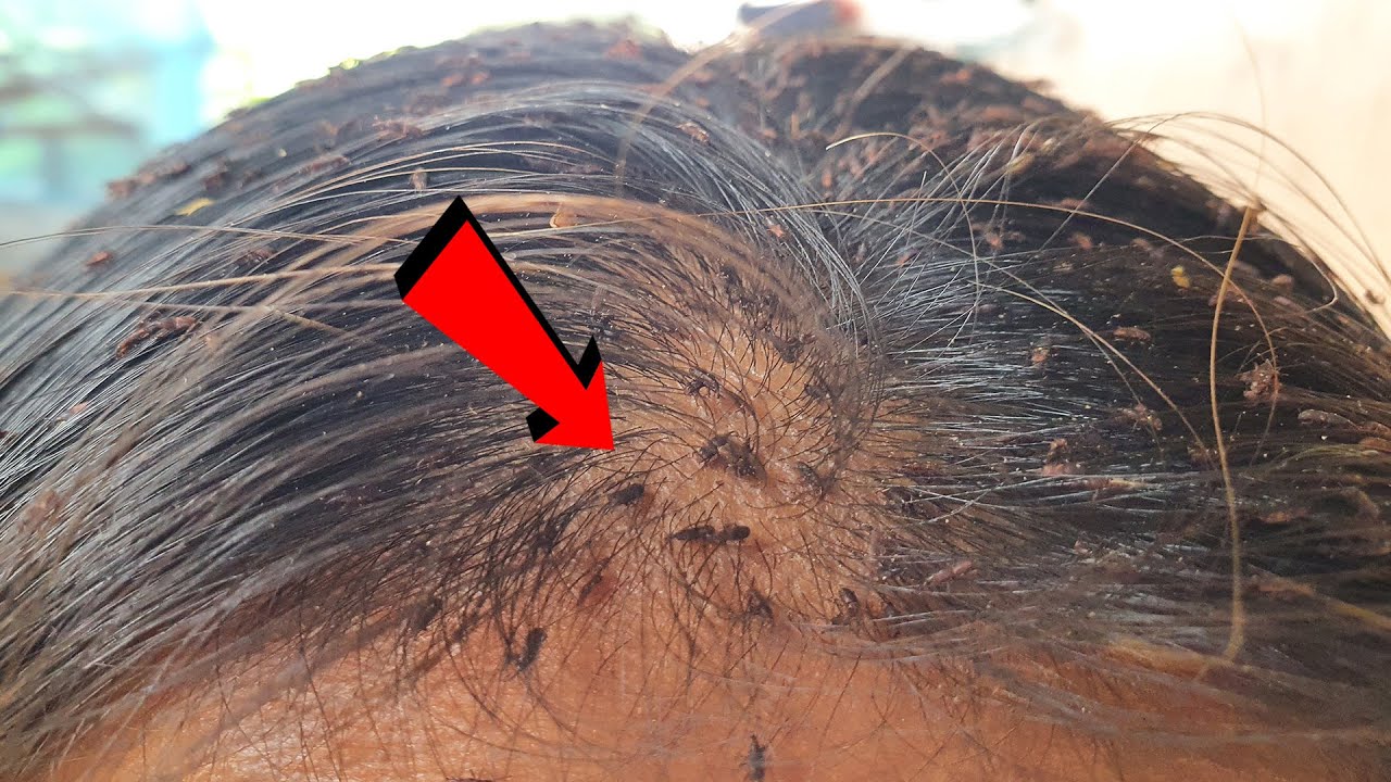 Remove big lice on long hair guy - Giant lice combing - YouTube
