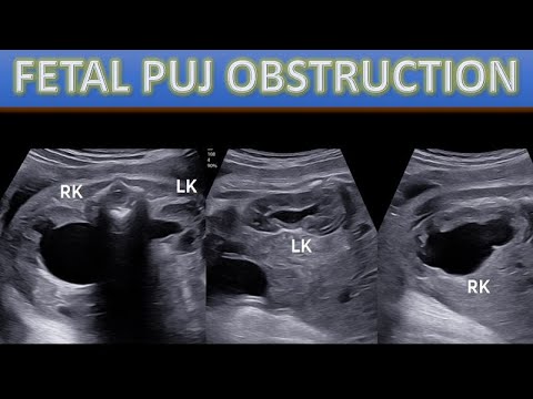 PUJ OBSTRUCTION IN FETAL RIGHT KIDNEY || LYING DOWN ADRENAL - YouTube