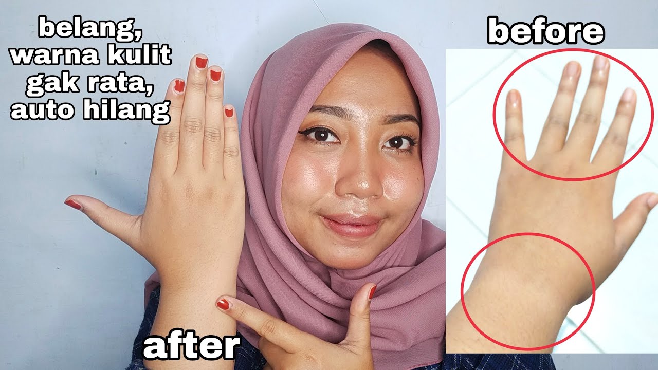 CARA MENGHILANGKAN BELANG DI TANGAN DENGAN CEPAT - YouTube