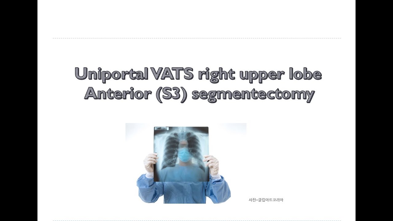 [#5] Uniportal VATS right upper lobe anterior segmentectomy (S3) for ...