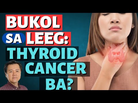Bukol sa Leeg: Thyroid Can-cer Ba? - By Doc Willie Ong (Internist and ...