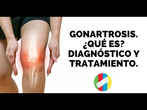 GONARTROSIS. ¿Qué es?, Diagnóstico y Tratamiento.