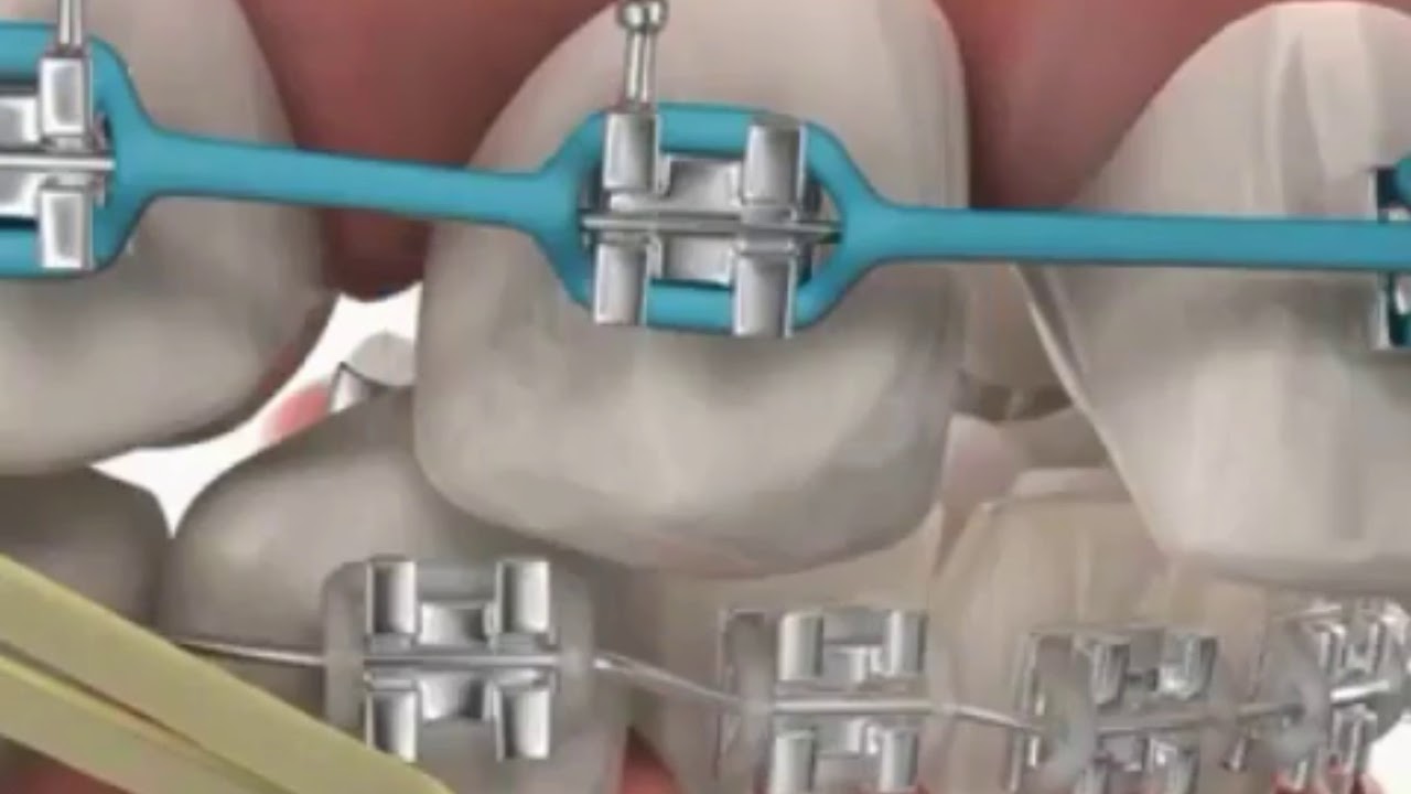 Ortodoncia con elásticos intermaxilares - YouTube