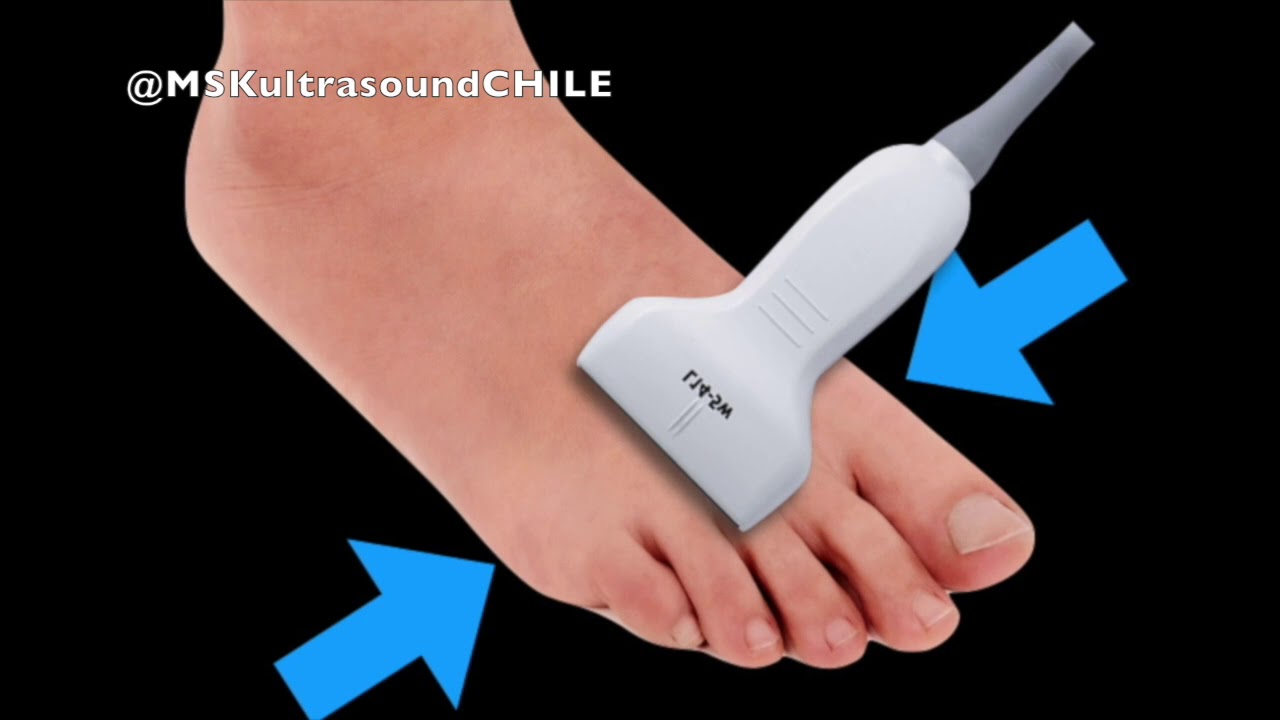 Foot: Morton's neuroma and intermetatarsal bursitis. - YouTube