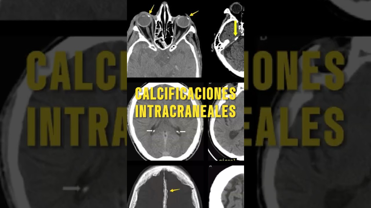 Intracranial calcifications by tomography #Radiology #Neuroimaging # ...