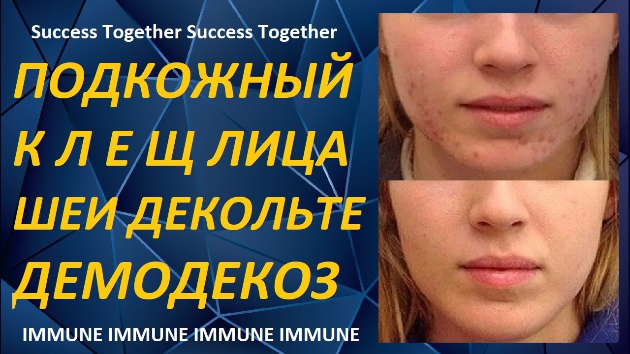 Подкожный Клещ Лечение Демодекоз Elev8 Отзывы Bepic Результаты Успех Вместе Success Together ...