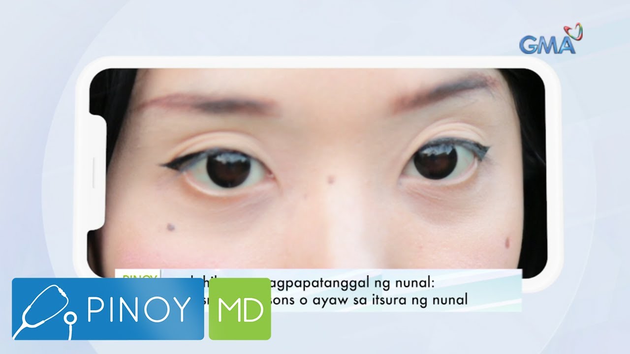 Ligtas ba ang pagpapatanggal ng nunal? | Pinoy MD - YouTube