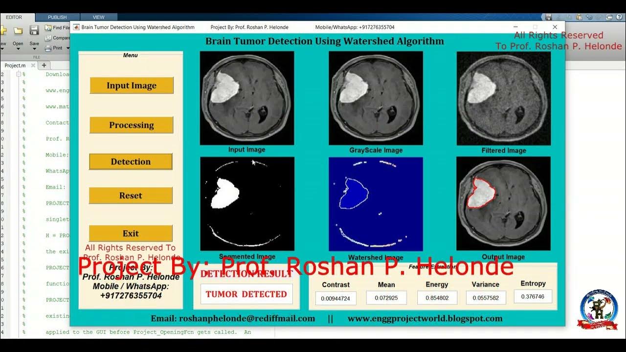 Brain Tumor Detection Using Watershed Algorithm With Source Code | Brain Tumor Detection Matlab ...
