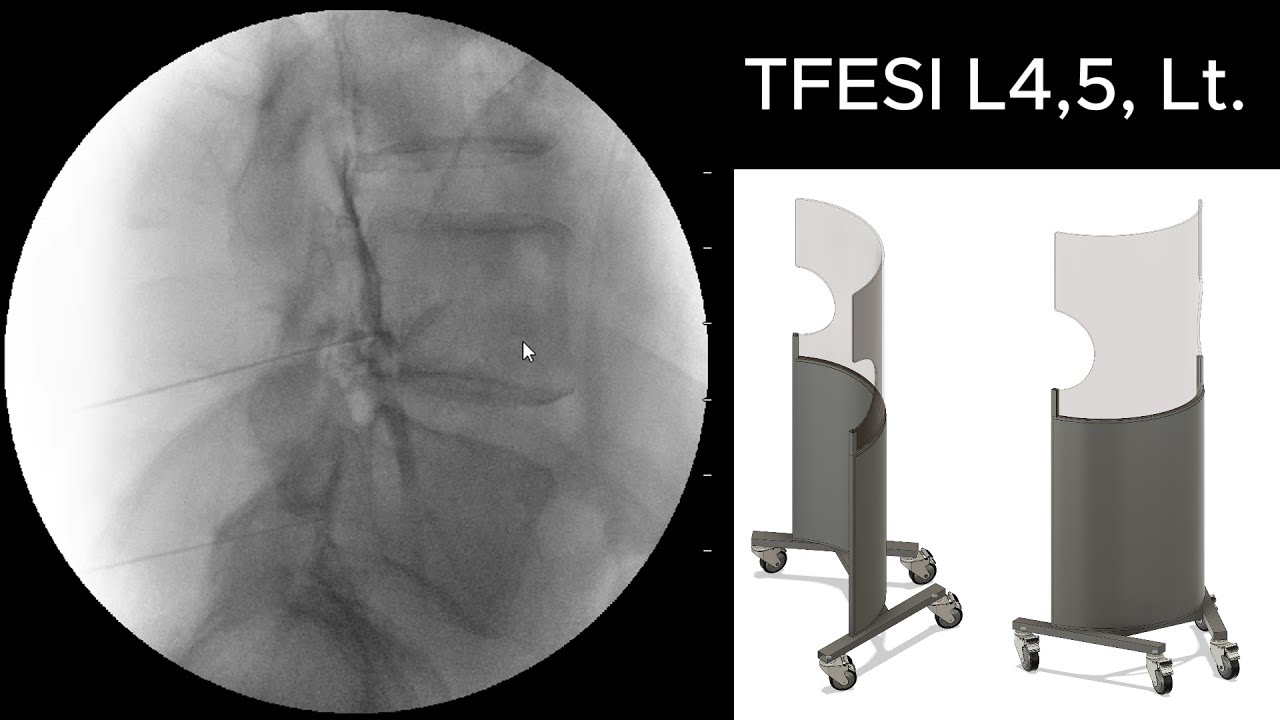 L4 Transforaminal Epidural Steroid Injection (TFESI) 정확하게 하는 방법 (5 ...