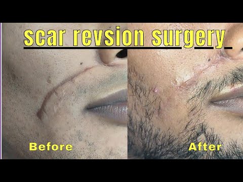 Scar revision surgery -1 month follow up result | Scar revision surgery ...