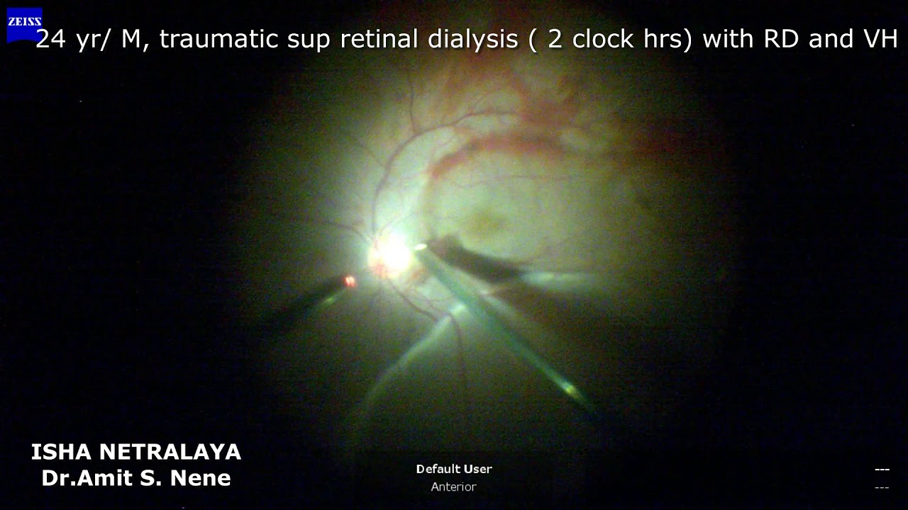 Traumatic retinal dialysis, RD with VH - YouTube