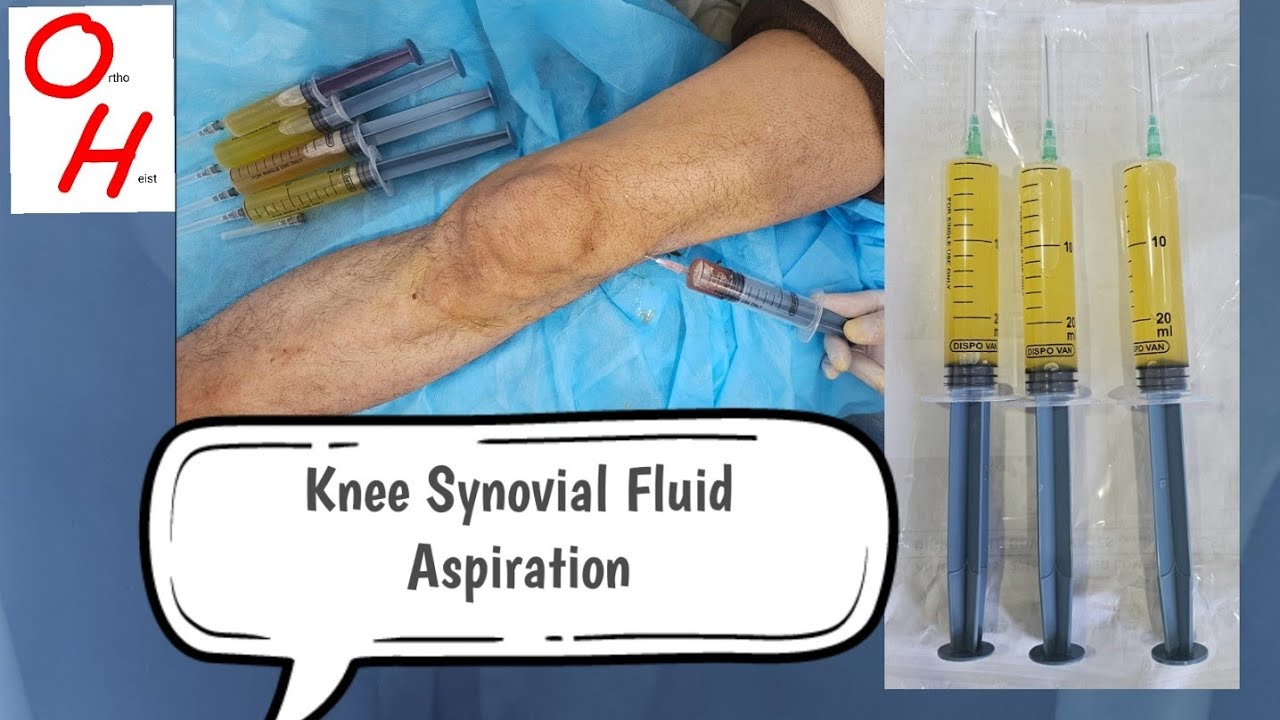 LEARN EASILY HOW TO PERFORM SYNOVIAL FLUID ASPIRATION FROM KNEE - YouTube