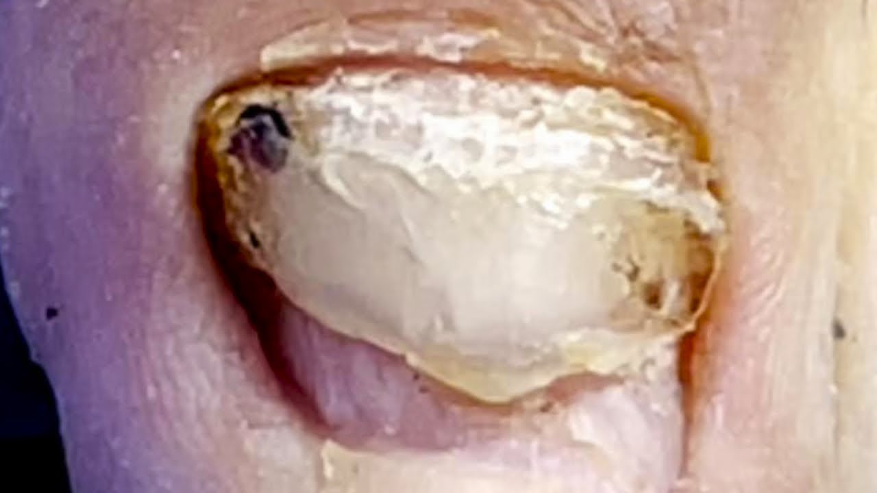 There are big grooves on toenails, foot care - YouTube