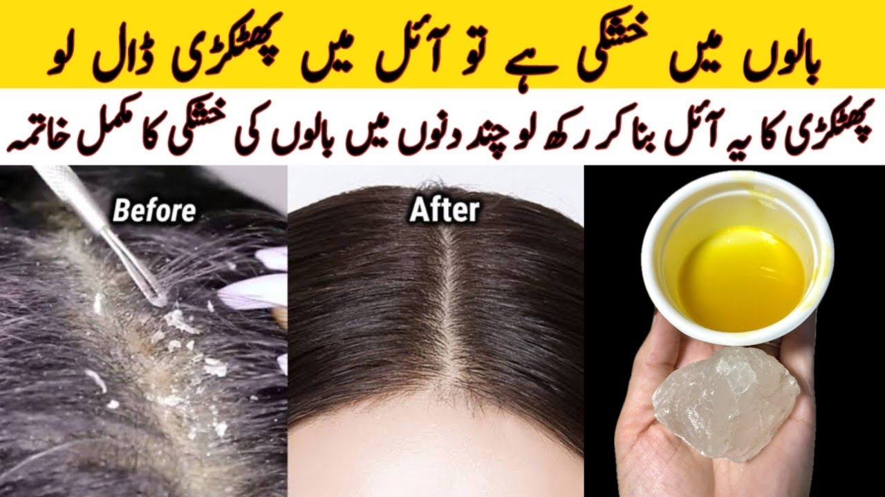 Homemade Anti Dandruff Secret | Alum Hair Oil For Dandruff Free Hairs ...
