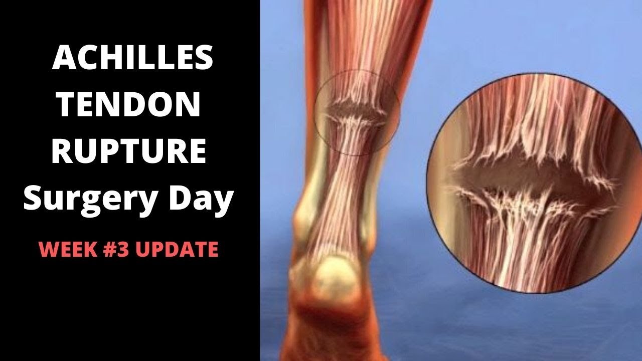 Achilles Rupture Surgery | Week #3 Update - YouTube