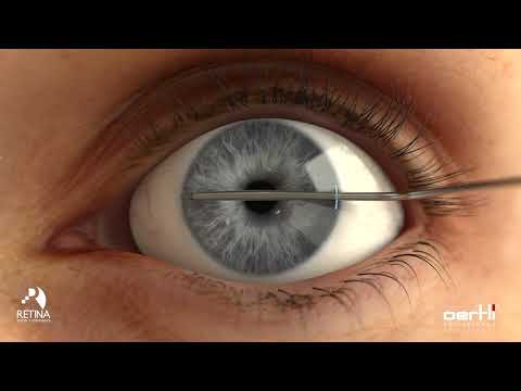 Tratamiento para glaucoma de ángulo abierto con HFDS | Oertli