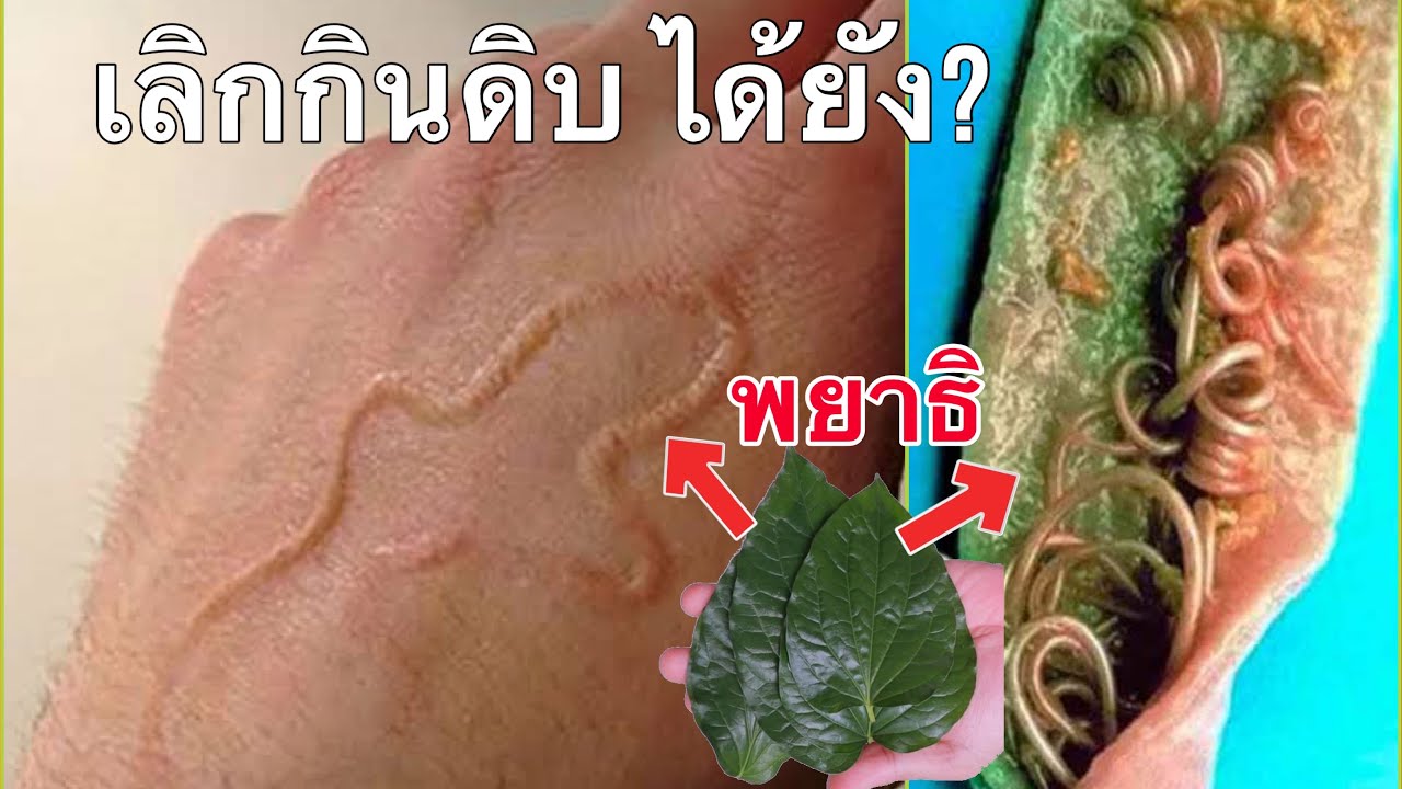 พยาธิ ยาถ่ายพยาธิด้วยสมุนไพร ง่ายๆได้ผล Parasite Cleanse | How To Get ...