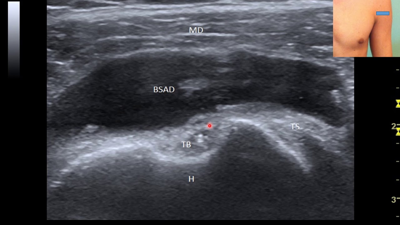 Ecografía sistemática hombro - YouTube