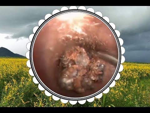 Huge Earwax | Candling and Insect in the Ears Removal - YouTube