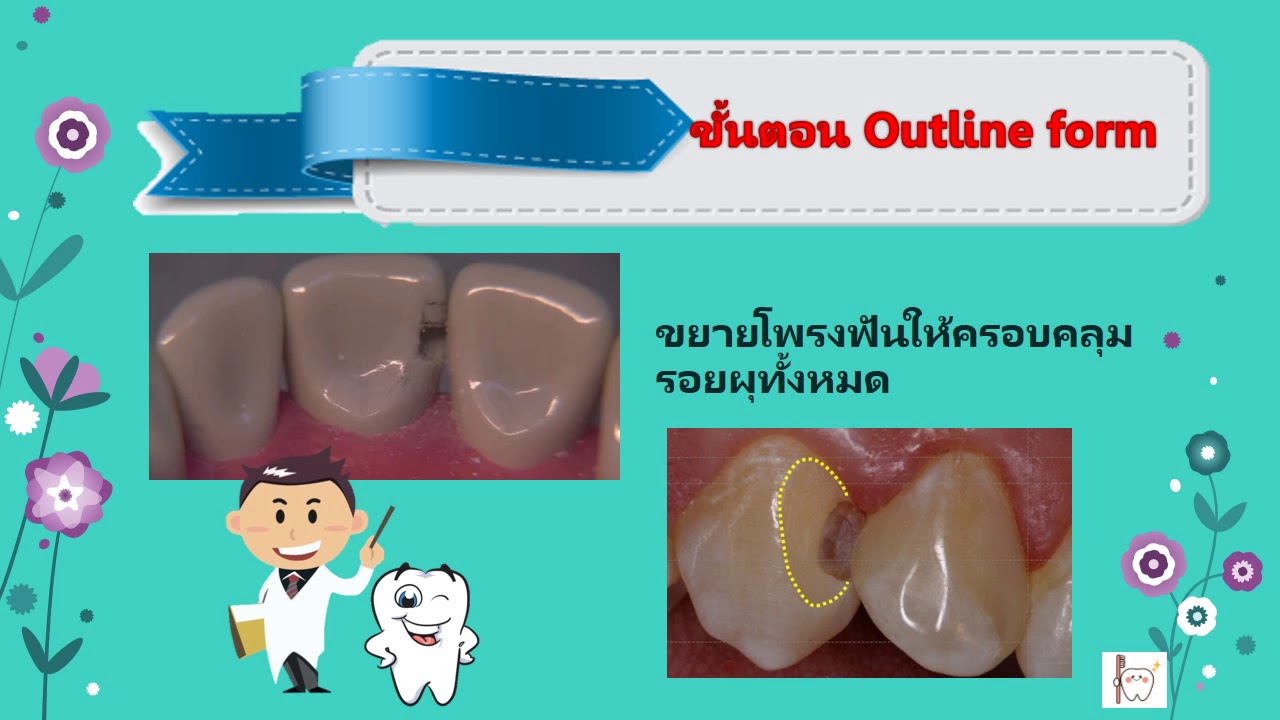 การอุดฟัน class ll & class lll - YouTube