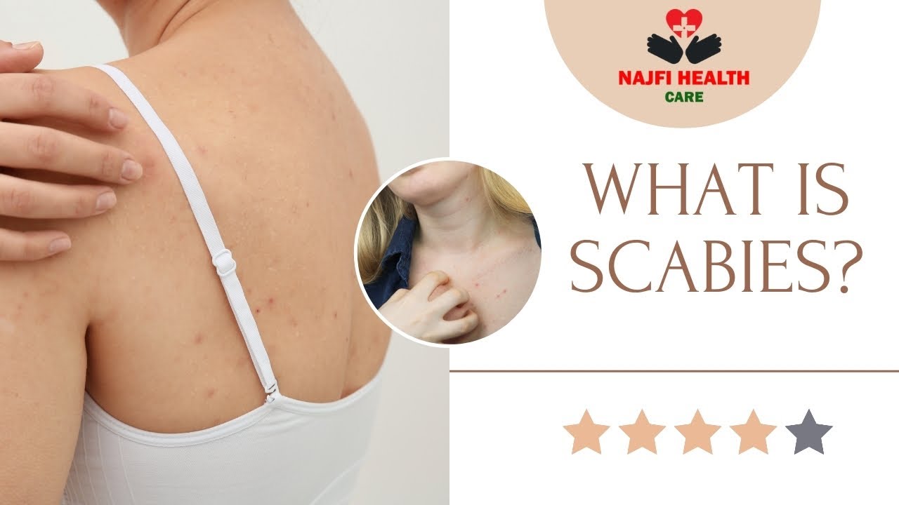 What Is Scabies? || Natural Treatment Of Scabies || Najfi Health Care ...
