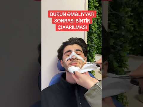 BİNT VƏ YA SLİKONLAR BURUN ƏMƏLİYYATINDAN 10 GÜN SONRA ÇIXARILIR #rinoplastika #burunəməliyyatı