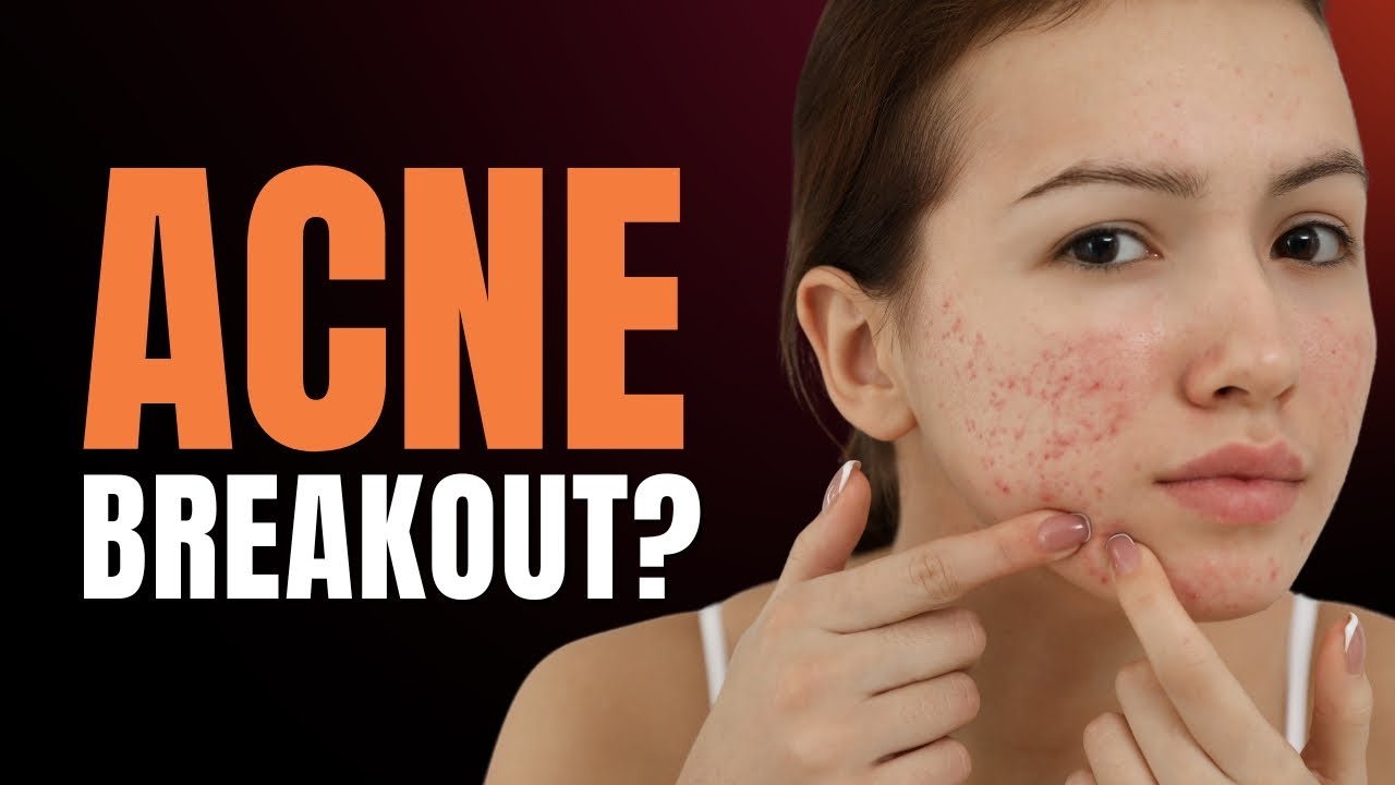 Understanding Major Types of Acne: Comedonal, Papulopustular, and ...