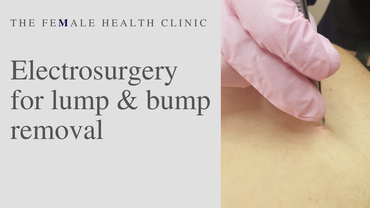 Electrosurgery for removing skin lumps & bumps - YouTube