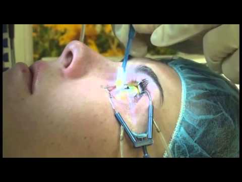 Lasik Xtra Procedure - YouTube