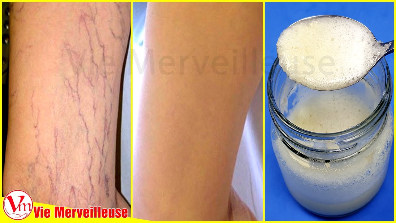 Enlever Les Varices Rapidement En Utilisant Ces 3 Ingrédients Naturels ...