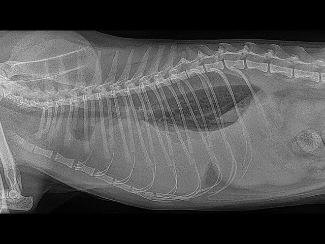 Pyothorax A Unique Case Of Tension Empyema Caused By Prevotella