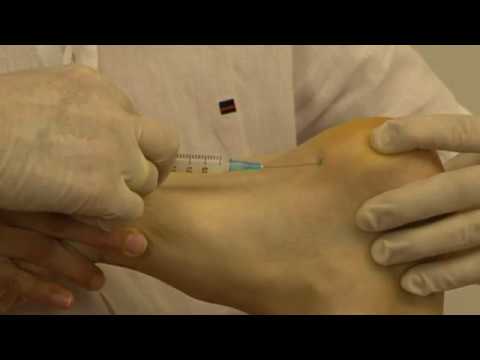 Plantar fasciitis injection - YouTube