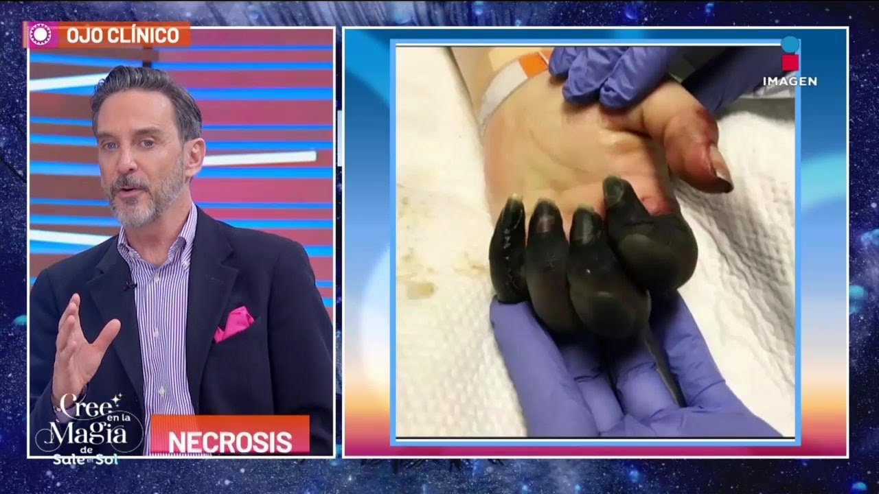Así se ve una mano con necrosis | Ojo Clínico | Sale el Sol - YouTube