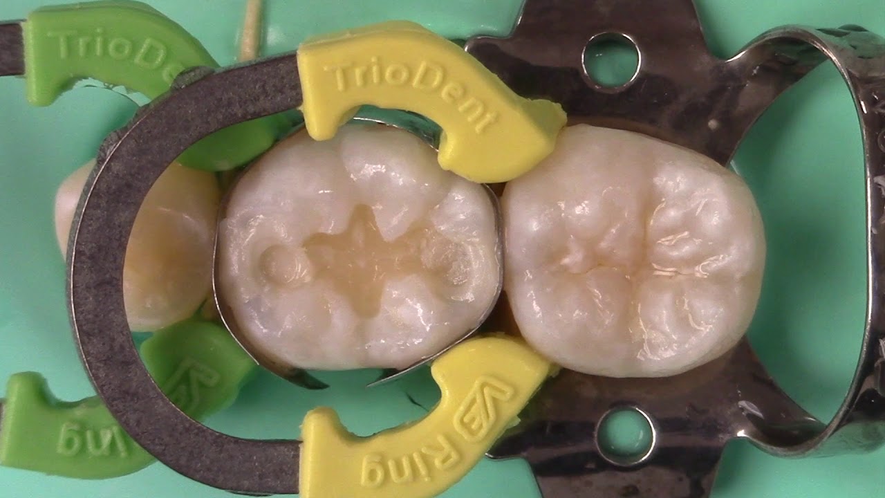 Class II composite - YouTube