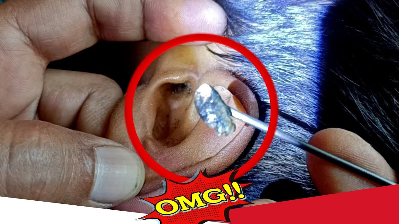Hardest Granite - like Ear Wax removal - YouTube
