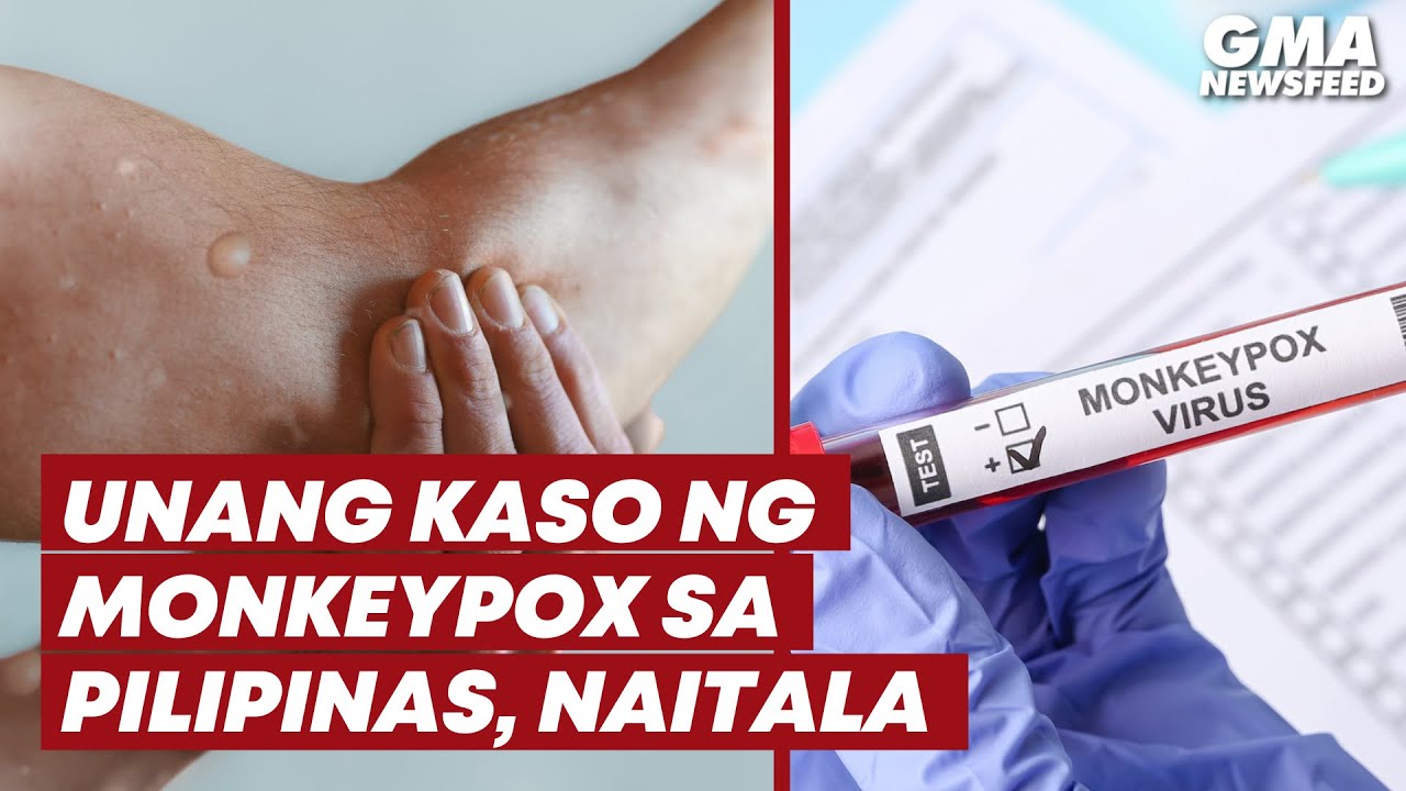 First case of monkeypox detected in the Philippines | GMA News Feed ...