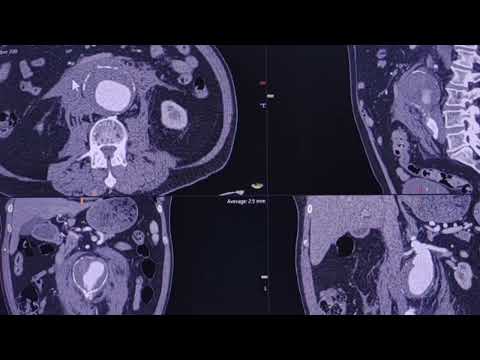 Types of Acute Aortic Pathology - CT - crescent sign - impending ...