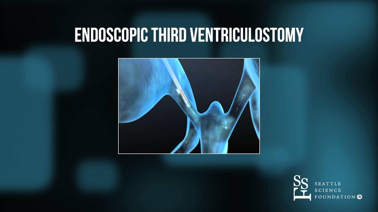 Endoscopic Third Ventriculostomy Animation - YouTube
