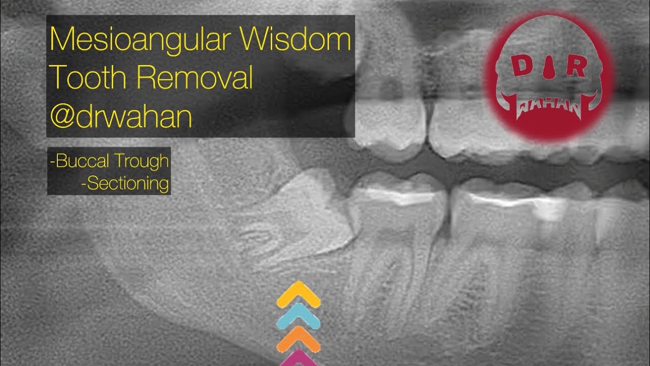 Black + White Version of Mesioangular Wisdom Tooth Extraction - YouTube