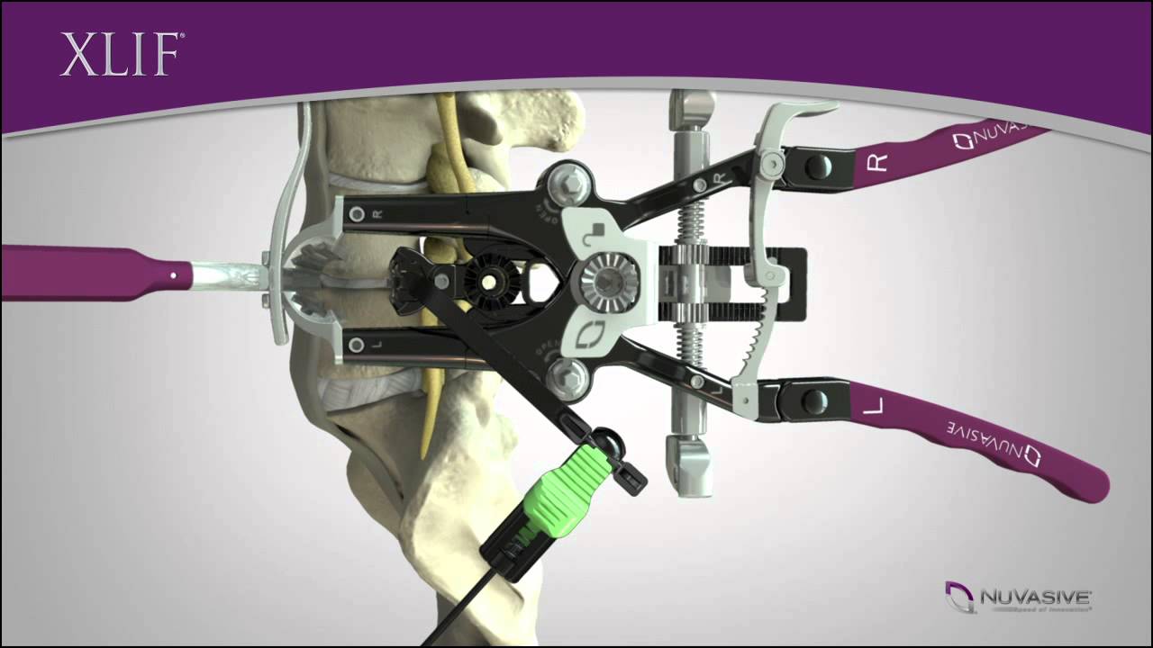 XLIF procedure animation - YouTube