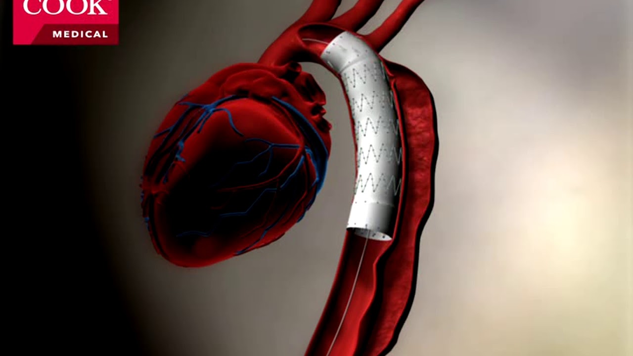 Tips & tricks en EVAR y TEVAR - Video 148 - YouTube