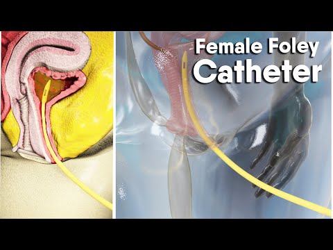 Female Foley Catheter | dandelion medical animation