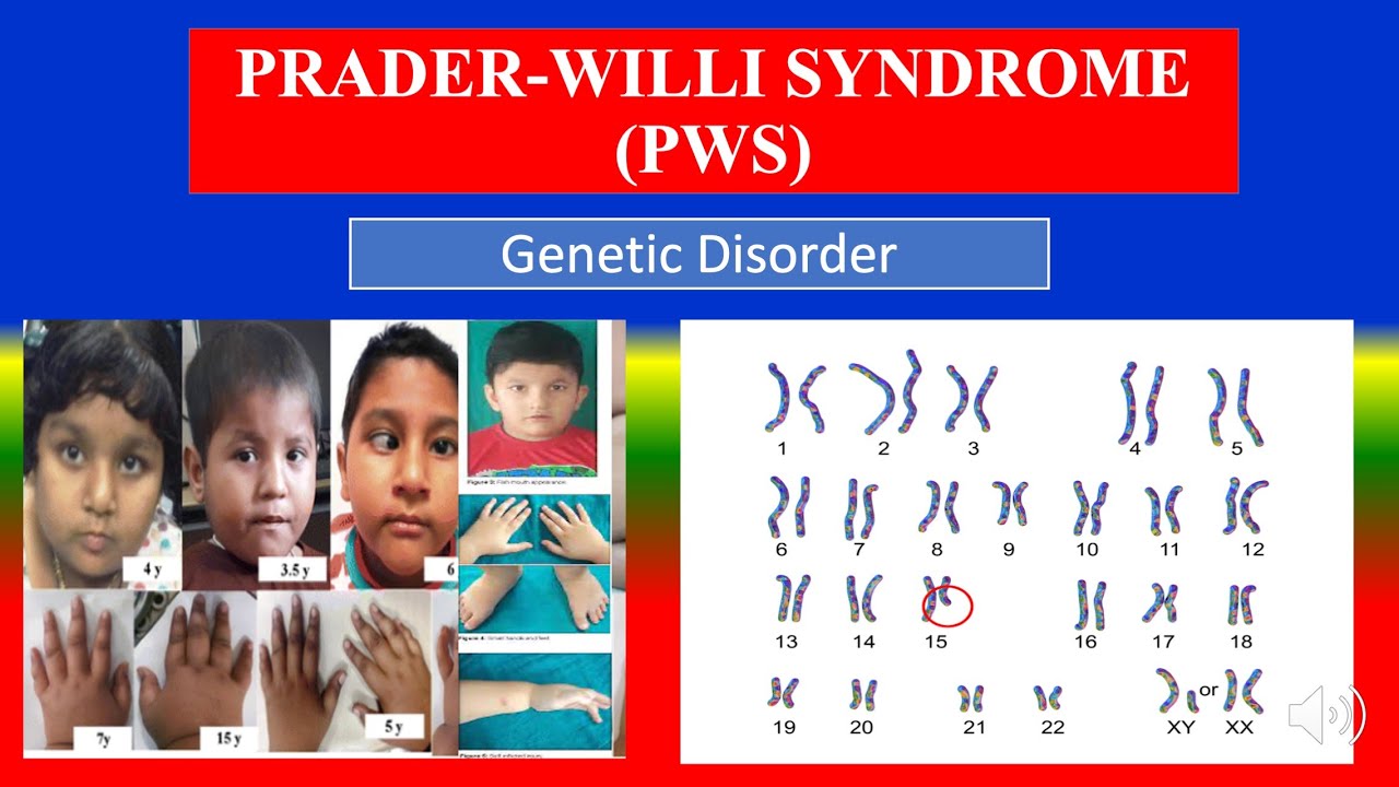 RADER WILLI SYNDROME (PWS) - Definition, types, cusses, pathophysiology ...