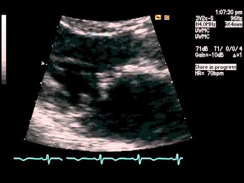 Echocardiography Showing Turbulent Flow at the Mitral Valve - YouTube