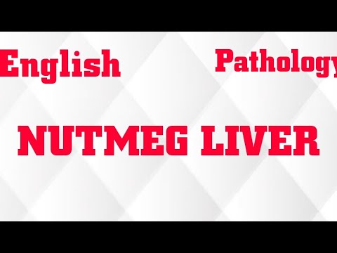 NUTMEG LIVER IN ENGLISH/ETIOLOGY/PATHOLOGY/GROSS APPEARANCE/MICROSCOPIC ...