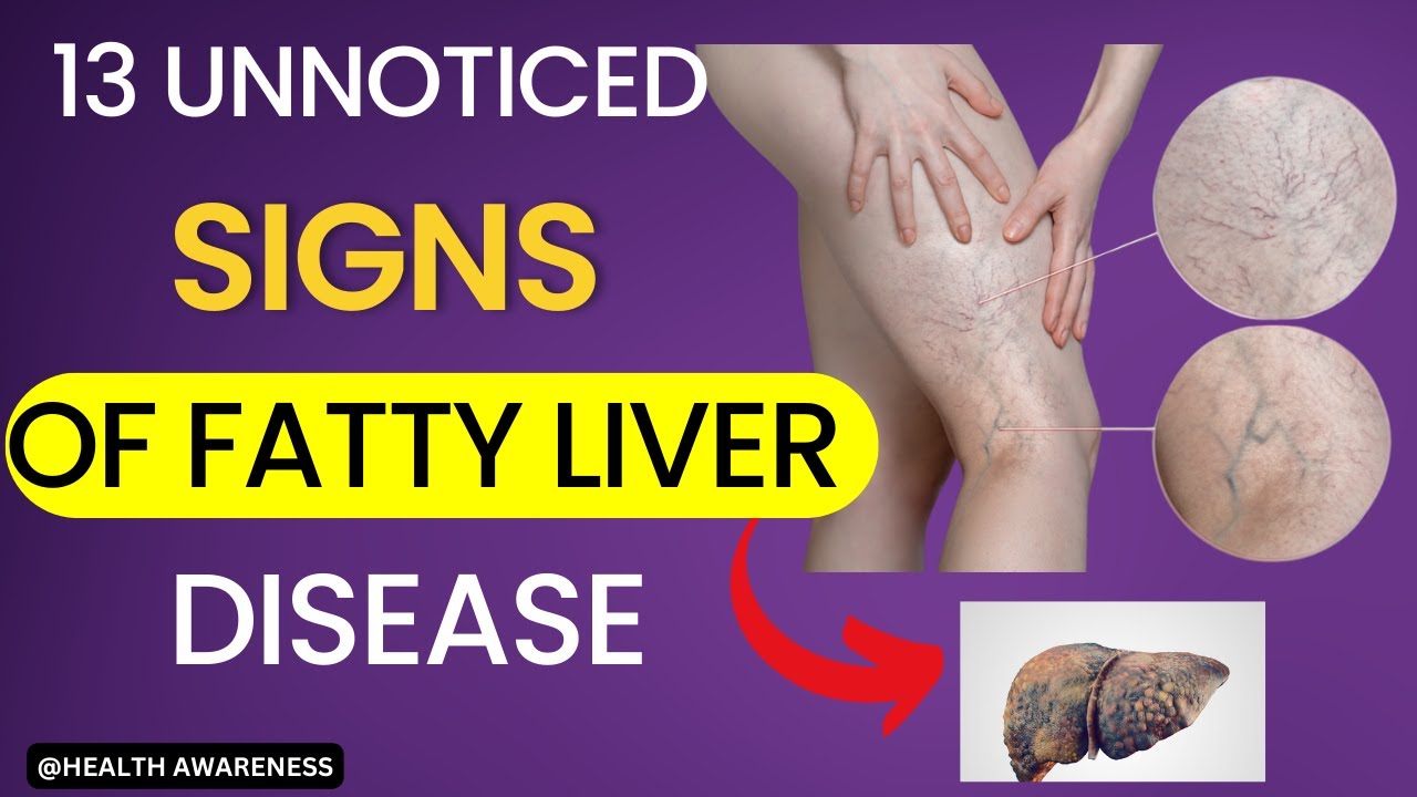 13 Unnoticed Signs of Fatty Liver Disease || Here Are Early Symptoms To ...