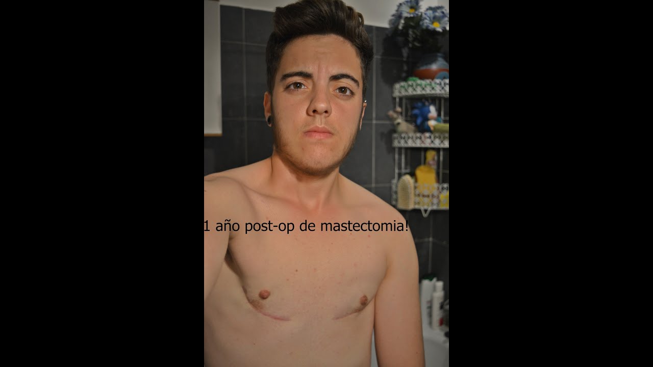 1 año post-op mastectomia/1 año y medio en T | Javier FTM - YouTube