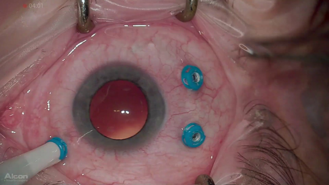 Diabetic peeling - YouTube