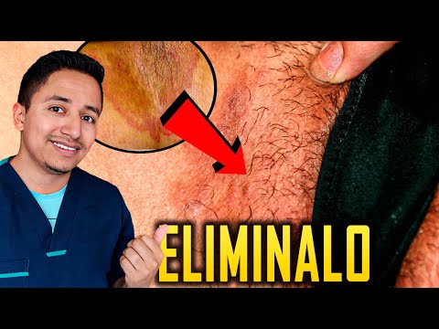 Cómo CURAR la Tiña Inguinal, medicamentos para el hongo de la Ingle
